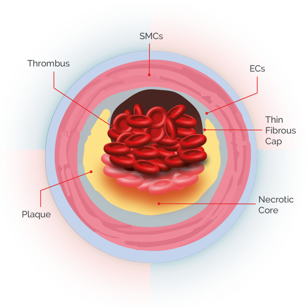 What is Lp(a) | Lipoprotein(a)